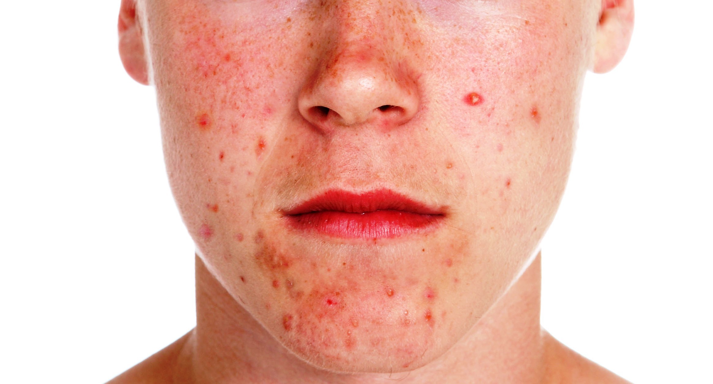 Ter acne até pode ter vantagens: borbulhas na adolescência retardam envelhecimento da pele ...